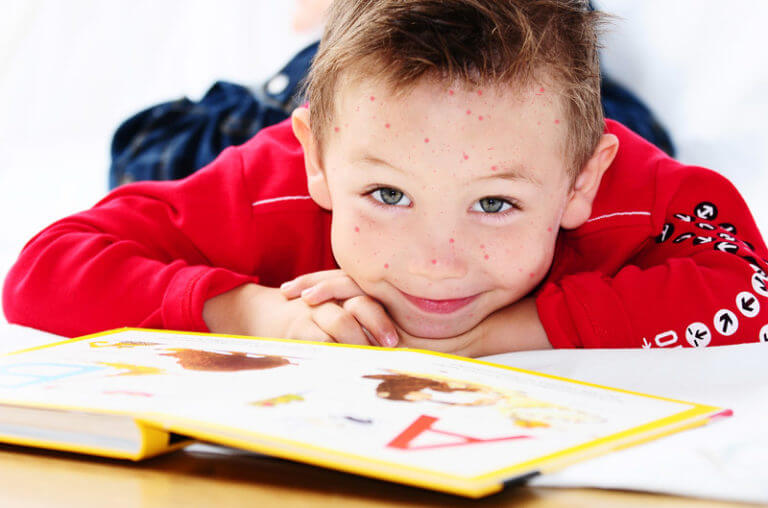 Masern | Kinderkrankheiten » gesund.co.at