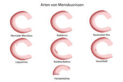 Meniskusriss: Arten, Symptome, optimale Therapie » gesund.co.at