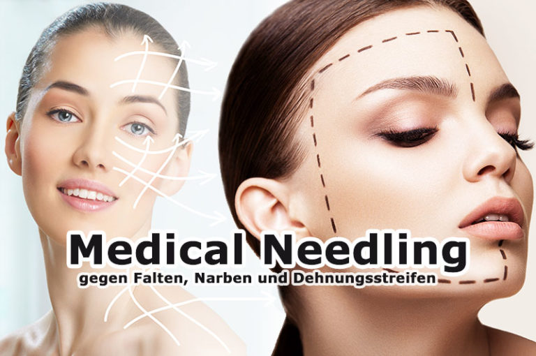 Medical Needling gegen Falten und Narben » gesund.co.at