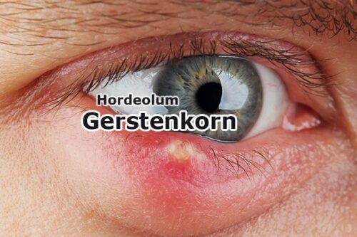Augenentzündungen: Gerstenkorn & Hagelkorn - Ursachen & Behandlung ...
